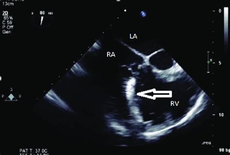 Mid Esophageal Rv Inflow Outflow View Showing Aso Device Arrow Download Scientific Diagram