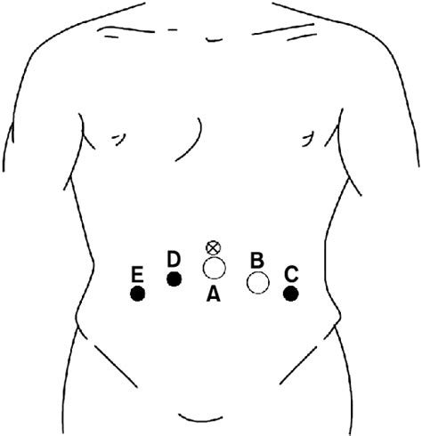 Figure 1 From Laparoscopic Partial Cystectomy For Adenocarcinoma Of The Bladder Semantic Scholar