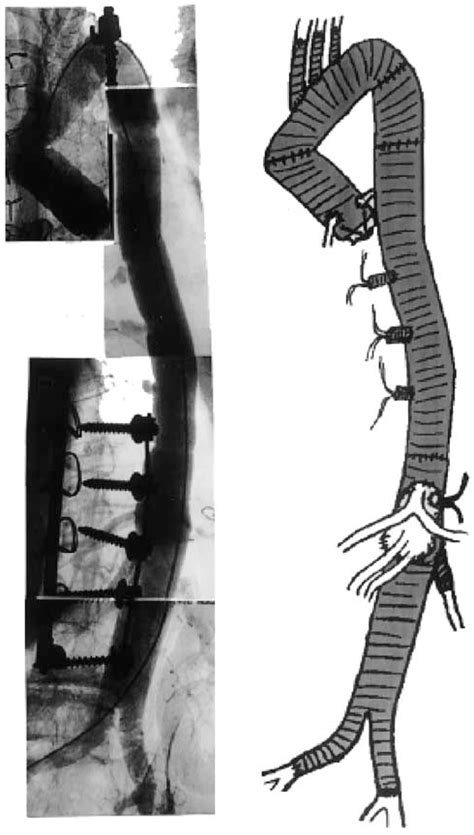 Figure 1 From Retrograde Segmental Aortic Repair For Type Ii