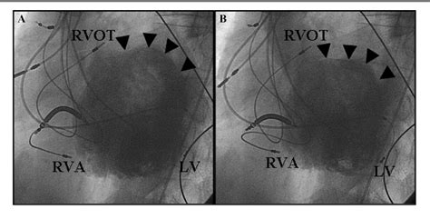 Figure 1 From Triangle Ventricular Pacing In A Non Responder To Conventional Bi Ventricular