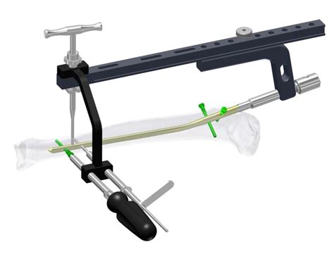 Rocky Tibia Nailing System