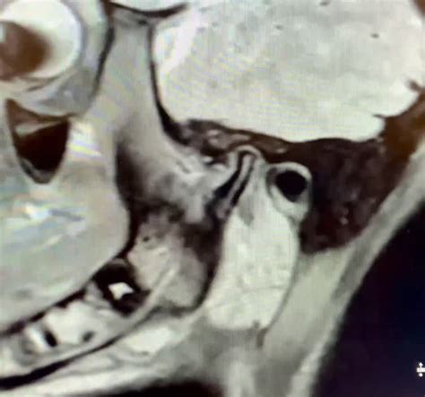 Ahmed Shehab El Dien On Linkedin Mri Dynamic Tmj Tmj Disc Dislocation Without Reduction