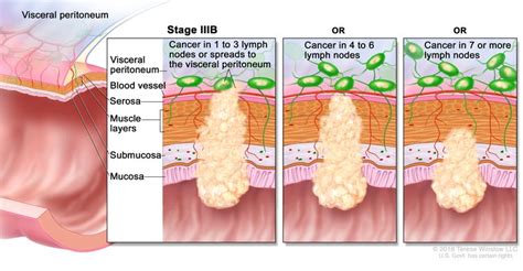 Colon Cancer Treatment Pdq® Nci