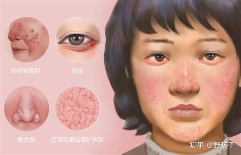 脂溢性皮炎、玫瑰痤疮的区别？ 知乎