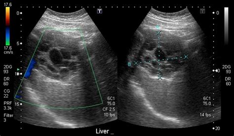 Hydatid Cyst