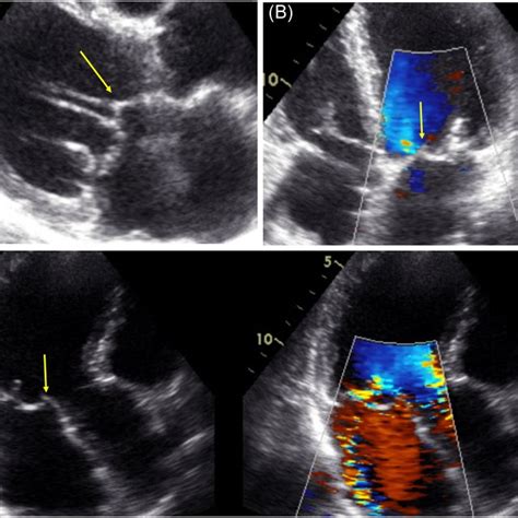 Fibroepithelial Polyp Arising From The Posterior Vaginal Wall