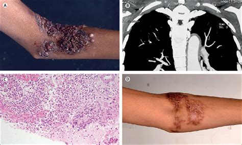 Takayasu Arteritis With Pyoderma Gangrenosum And Superficial