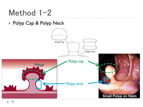 Ppt Polyp Detection Powerpoint Presentation Free Download Id2609039