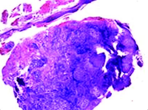 Upper And Lower Dermal Nodular Granulomatous Infiltrates H And E ×10