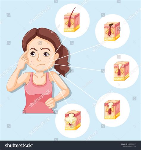Scientific Medical Illustration Pimple Formation Illustration Stock Vector Royalty Free