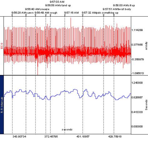 New Method Removes Hrv Artifact Biopac