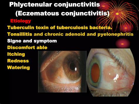 Conjunctival Diseases By Dr Abdul Basir Safi Ppt Ear Nose And
