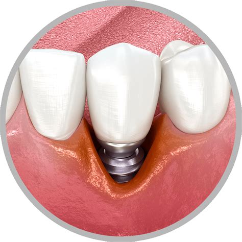Peri Implantitis Cascade Dental Implants Failing Implants