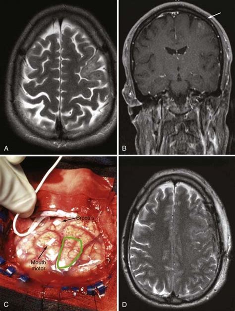 Malignant Gliomas Neupsy Key