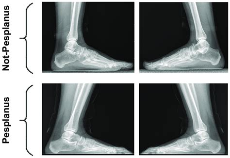 Randomly Selected X Ray Images From The Labeled Pes Planus Dataset Download Scientific Diagram