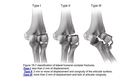 Lateral Condylar Fractures Of The Distal Humerus Pptx Lateral Condylar Fractures Of The Distal Humerus Pptx
