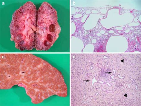 Diffuse Cystic Renal Dysplasia And Congenital Hepatic Fibrosis A Cut