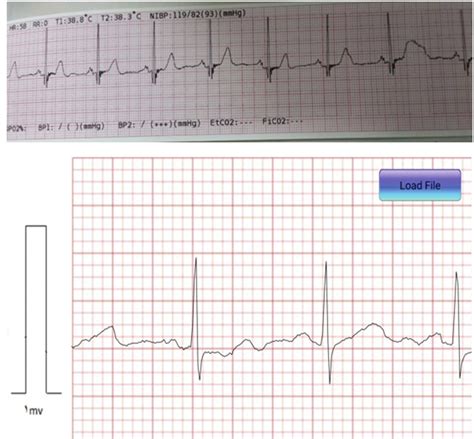 A Sample Of Electrocardiographic Signal From The Designed System And Download Scientific