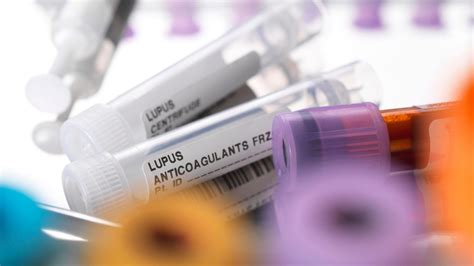 Lupus A Laymans Guide Nugenomics
