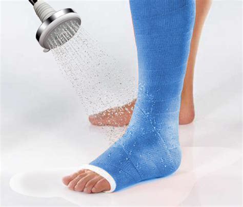 Гіпс чи скотчкаст Поради травматолога