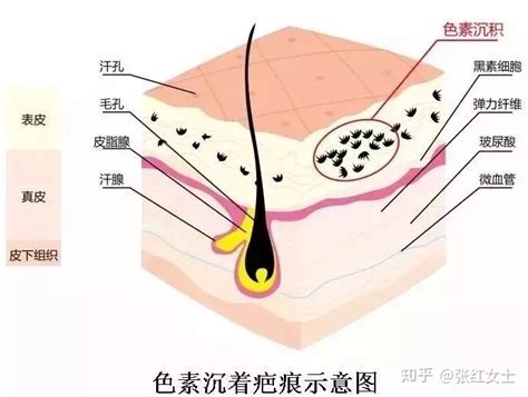 疤痕科普你疤痕的颜色是不是发黑 知乎