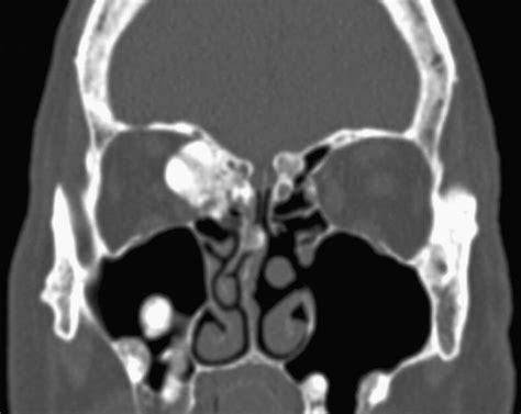 Osteoma Of The Skull Base And Sinuses Otolaryngologic Clinics Of