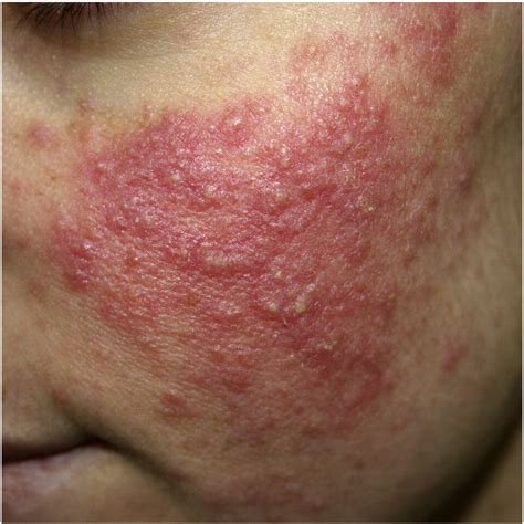 Rosacea And Rhinophyma Clinics In Dermatology
