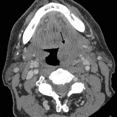 Tonsils Labeled Ct At Caitlin Kelley Blog