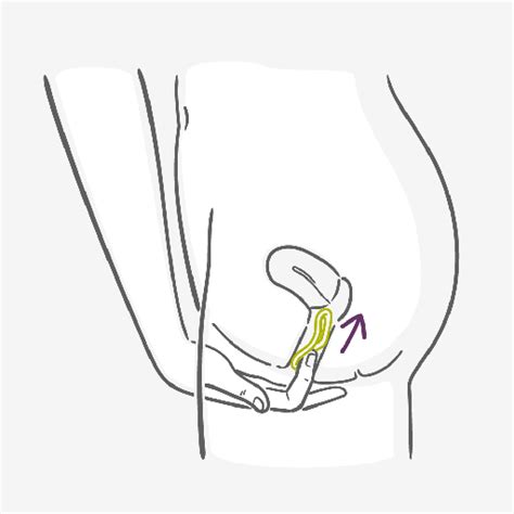 Contraceptive Ring Hormonal Method