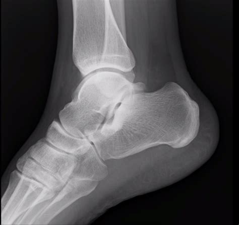 Processus Stieda Pacs