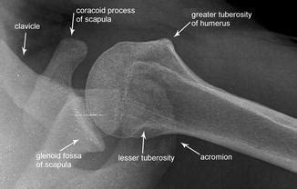 Lesser Tuberosity Of Humerus X Ray