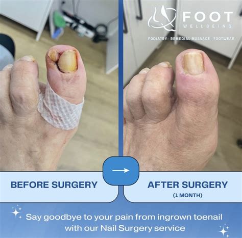 Ingrown Toenail Surgery Foot Wellbeing Podiatrists Footscray