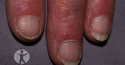 Chilblain Lupus Image