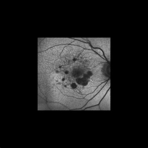 Spectralis Bluepeak Blue Laser Autofluorescence Heidelberg Engineering