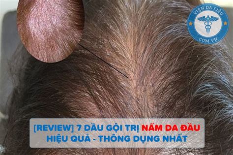 Review 7 DẦu GỘi TrỊ NẤm Da ĐẦu HiỆu QuẢ ThÔng DỤng NhẤt