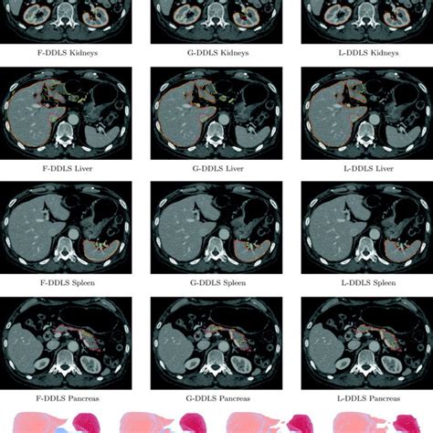 Pdf Discriminative Dictionary Learning For Abdominal Multi Organ