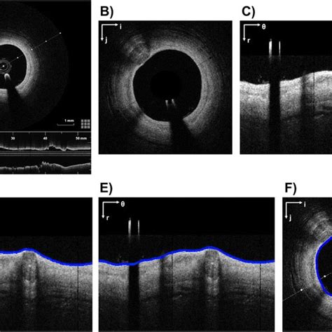 Example Of Lumen Detection Algorithm A Original Grayscale Oct Image B Download Scientific