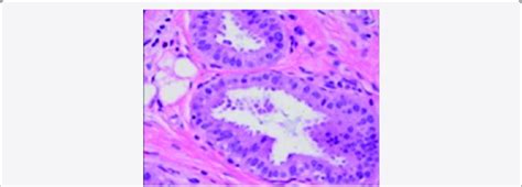 Ceruminous Adenoma Exemplifying A Glandular Arrangement With Two