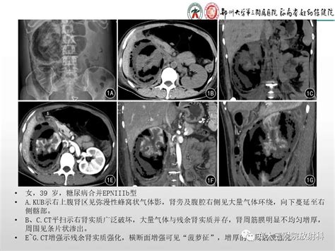 影像诊断急性肾炎肾炎 MedSci cn