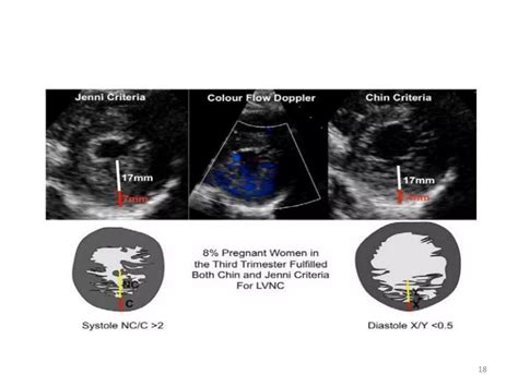 Left Ventricular Non Compaction Pptx