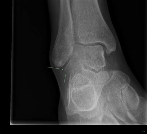 Talus Fracture