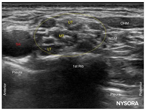 Ultrasoundguided Supraclavicular Brachial Plexus Block Brachial Plexus
