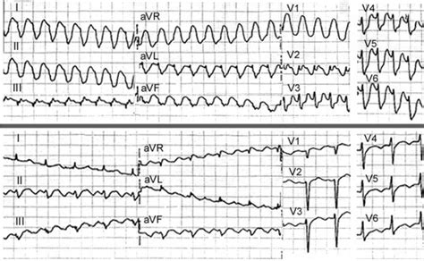 Atrial Flutter An Update Revista Española De Cardiología