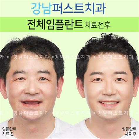 젊어지는치과 고난이도임플란트 퍼스트치과 환자분 개개인의 치아구조에 맞는 맞춤 치료 계획을 통해