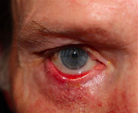 Before And After Gallery Oculofacial Reconstruction Doctor Rosh
