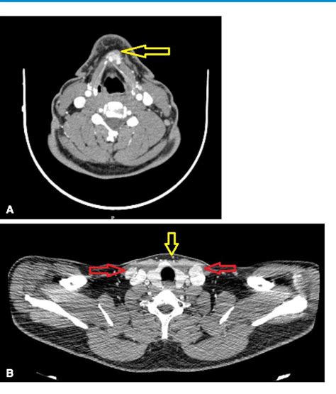 Figure 1 From Isolated Thyroid Carcinoma In An Ectopic Thyroid Tissue Semantic Scholar