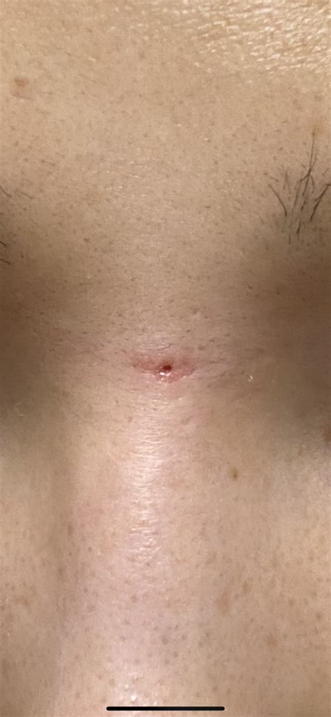 피부 구멍 지식in