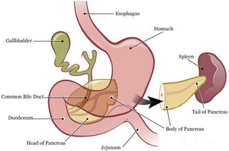 Distal Pancreatectomy