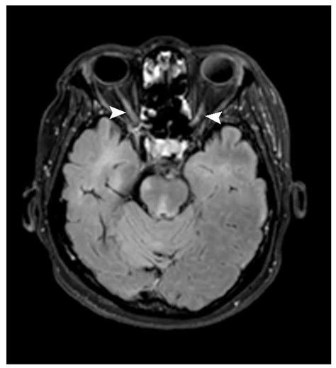 Axial Post Contrast Flair Image Shows Patchy Enhancement At Posterior