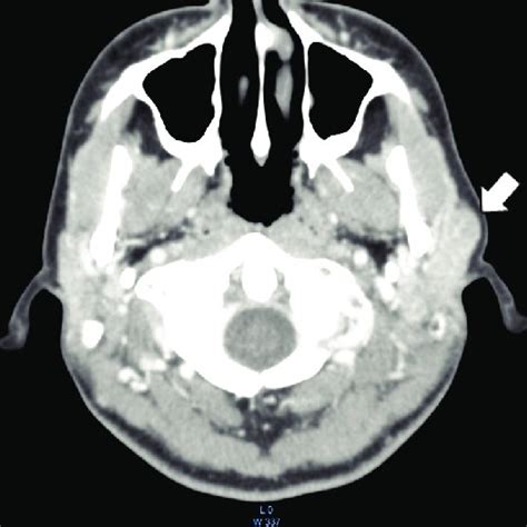 Preauricular Lymph Node Enlargement Download Scientific Diagram